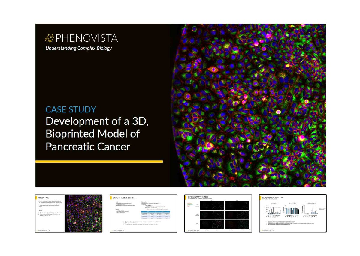 Development of a 3D, Bioprinted Model of Pancreatic Cancer